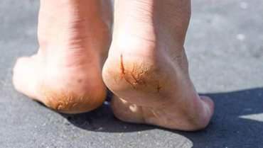 Fissures - Burbank Podiatrist | Los Angeles Foot & Ankle Center