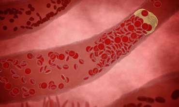 Peripheral Artery Disease - Burbank Podiatrist | Los Angeles Foot ...