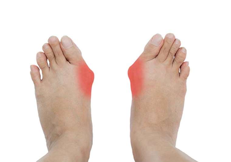 Best Bunion Doctor in Los Angeles - Burbank Podiatrist | Los Angeles ...